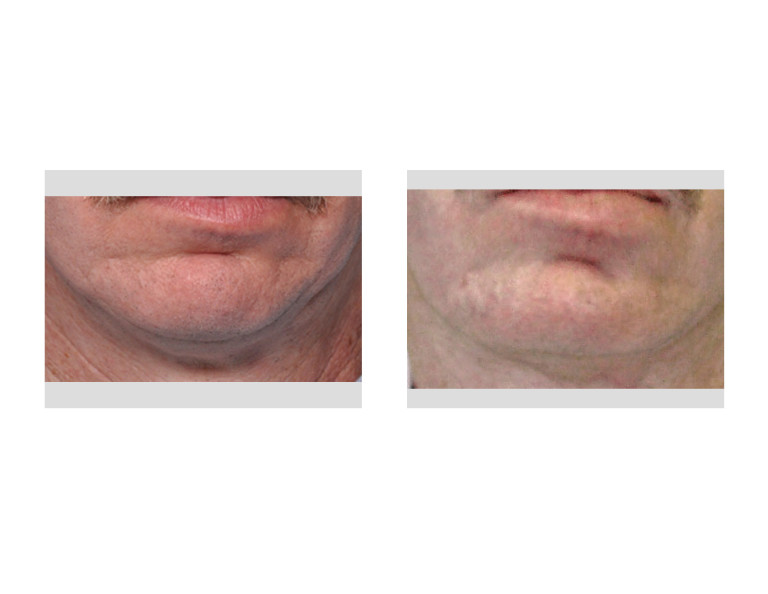 Plastic Surgery Case Study - Square Chin Implant in Men - Explore ...