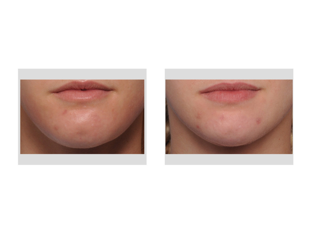 Plastic Surgery Case Study - Female Submental Chin Reduction - Explore ...