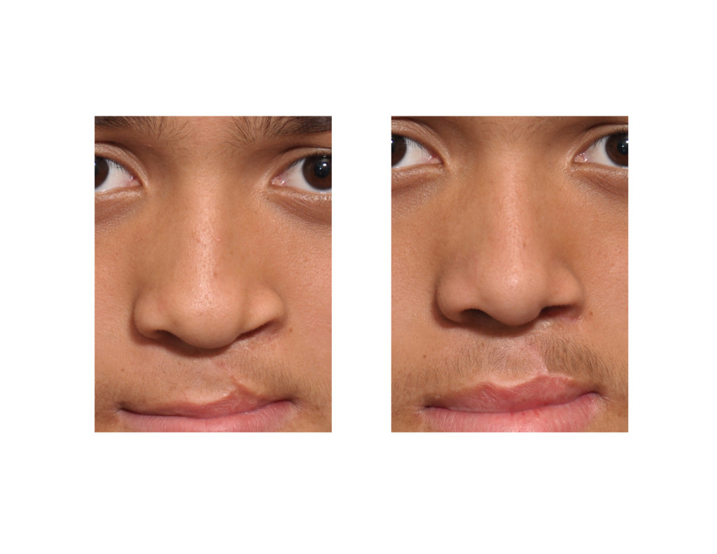 Cleft Rhinoplasty and Cleft Lip Revision result front view Dr Barry ...
