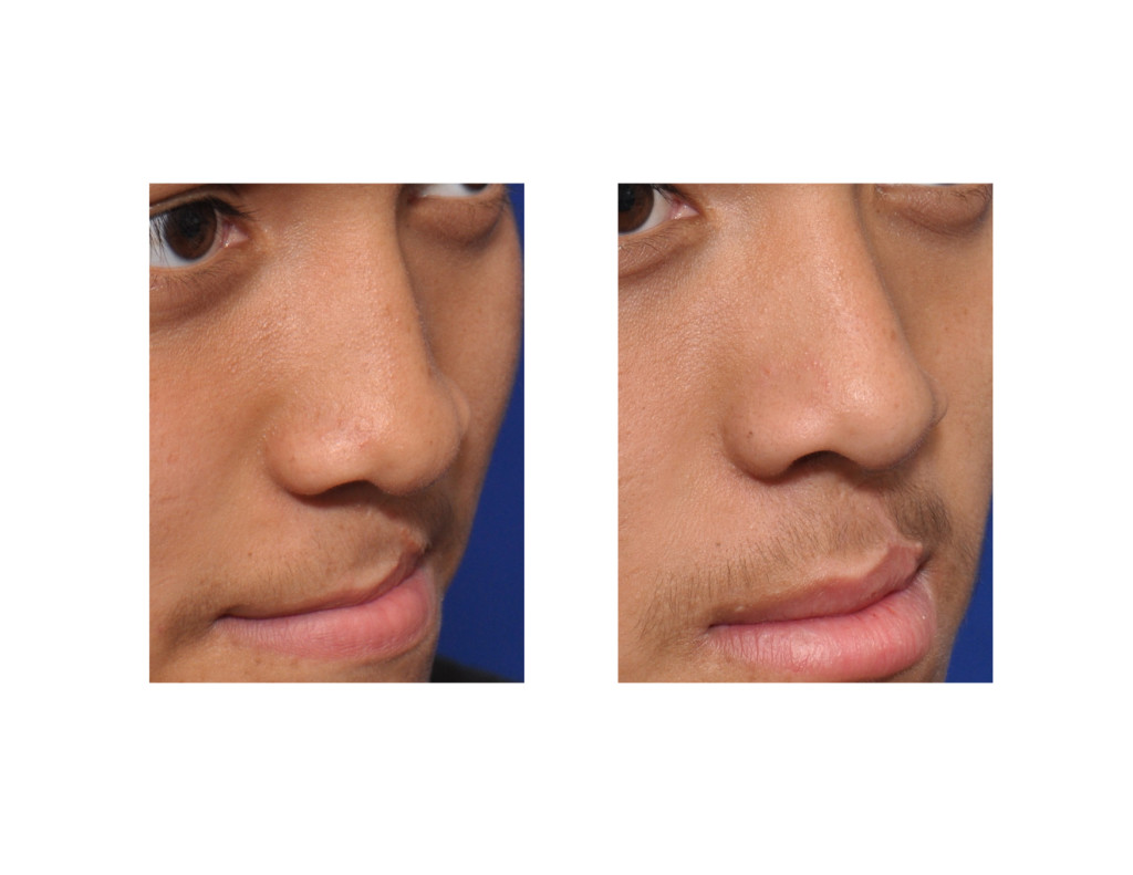 Plastic Surgery Case Study - The Cleft Septorhinoplasty - Explore ...