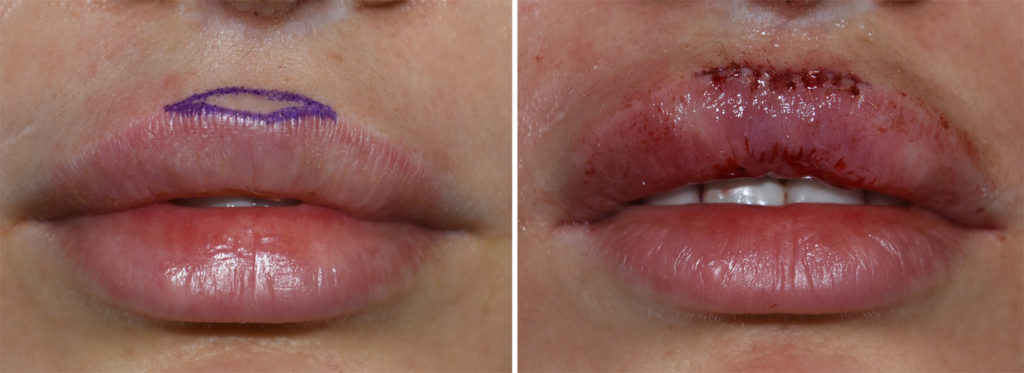 Cupid's Bow Reduction of the Upper Lip - Explore Plastic Surgery