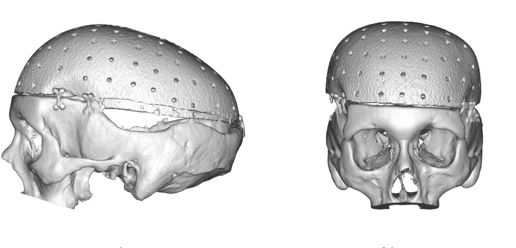 Plastic Surgery Case Study - Total Skull Implant with Onlay Bone Cement ...