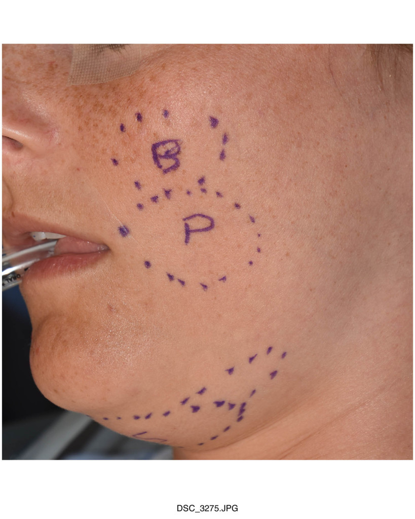 Facial Fat Reduction Zones Dr Barry Eppley Indianapolis - Explore ...