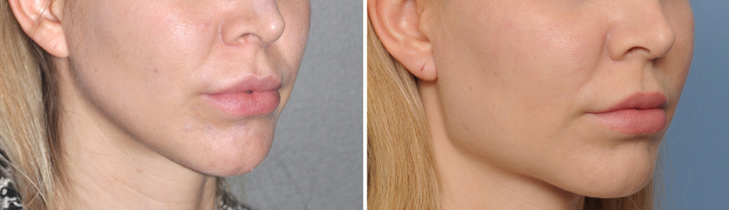 Plastic Surgery Case Study - Female Jaw Angle Implants for a More ...