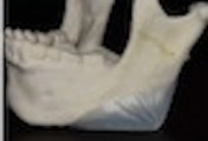 Vertical Lengthening Jaw Angle Implants design Dr Barry Eppley ...