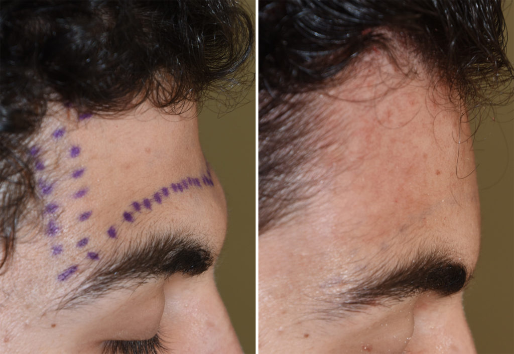 Plastic Surgery Case Study - Limited Incision in Male Forehead ...
