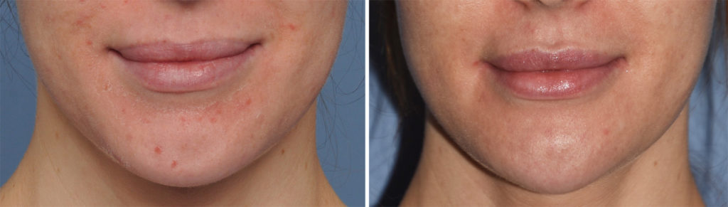 Technical Strategies - T-Shaped Osteotomy for Chin Width Reduction ...