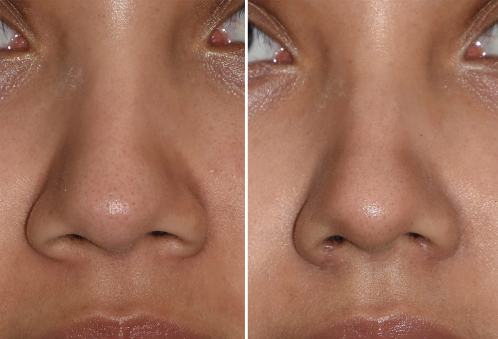 Plastic Surgery Case Study - Female Nostril Narrowing Surgery - Explore ...