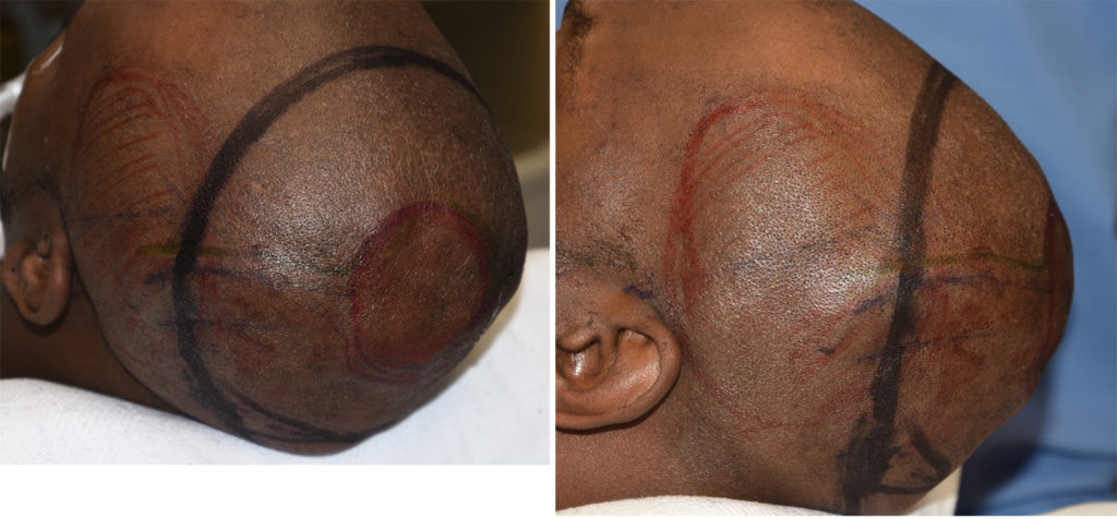 Plastic Surgery Case Study - Male Occipital Skull Reduction for Crown ...