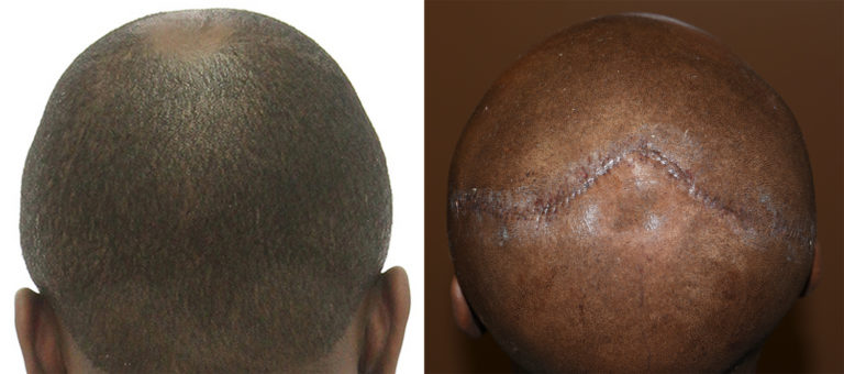 Plastic Surgery Case Study - Male Occipital Skull Reduction for Crown ...