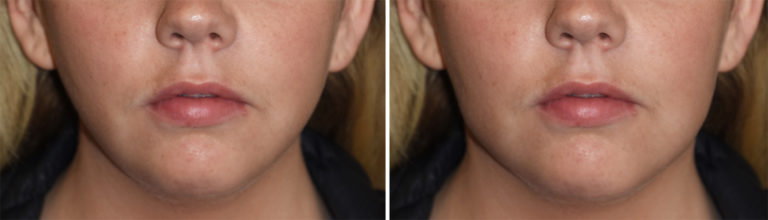 Plastic Surgery Case Study - Jaw Angle Implants after Orthognathic ...