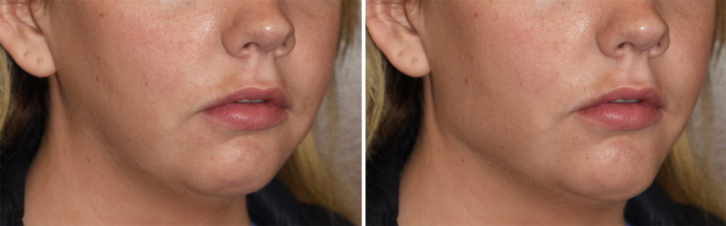 Plastic Surgery Case Study - Jaw Angle Implants after Orthognathic ...