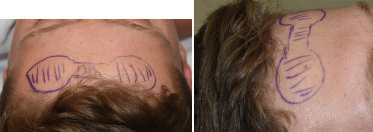 Plastic Surgery Case Study - Male Forehead Horn Reduction - Explore ...