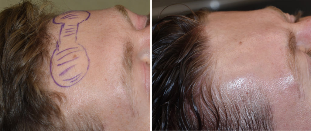 Plastic Surgery Case Study - Male Forehead Horn Reduction - Explore ...