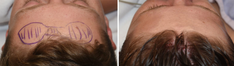 Plastic Surgery Case Study - Male Forehead Horn Reduction - Explore ...