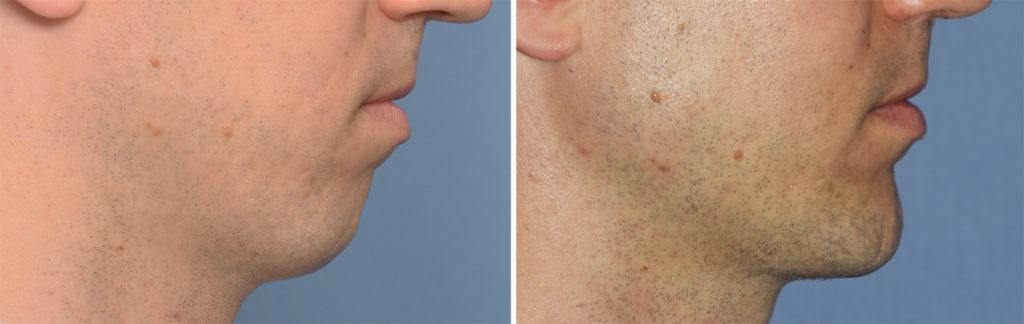 Plastic Surgery Case Study - Three-Piece Total Jawline Augmentation ...