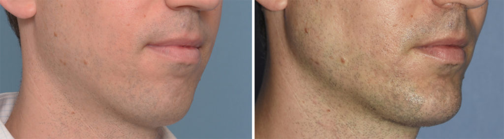 Plastic Surgery Case Study - Three-Piece Total Jawline Augmentation ...