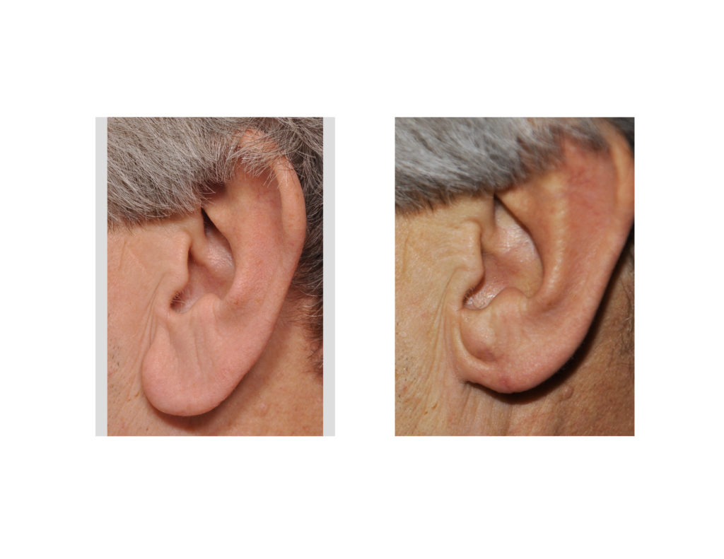 Techniques in Earlobe Reduction - Explore Plastic Surgery