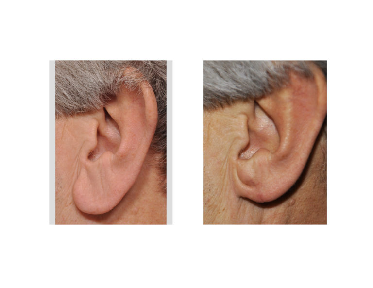 Left Earlobe Reduction Wedge Excision Results Dr Barry Eppley Indianapolis Explore Plastic Surgery