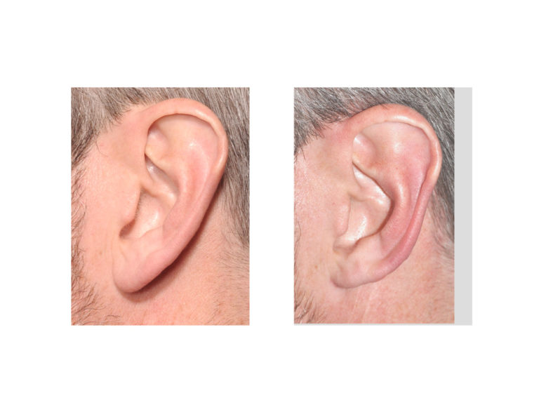 Techniques in Earlobe Reduction - Explore Plastic Surgery