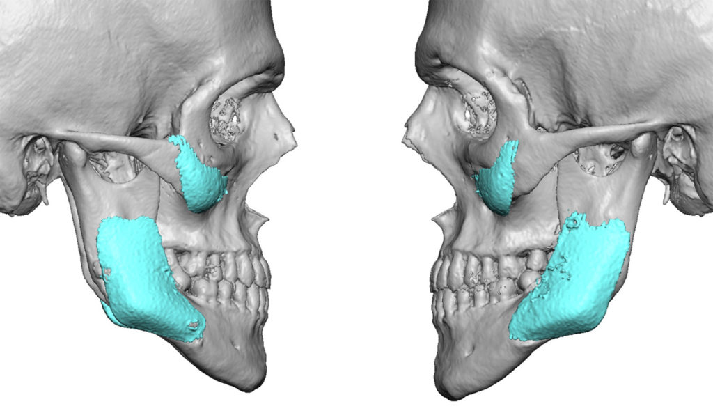 Choosing Widening vs Vertical Lengthening Jaw Angle Implant Styles ...