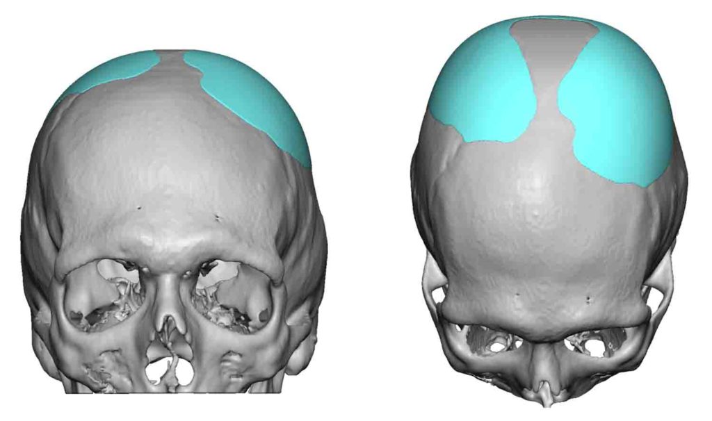 Plastic Surgery Case Study - Custom Skull Implant for Skull Contour ...