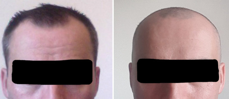 Plastic Surgery Case Study - Head Width Reduction by Posterior Temporal ...