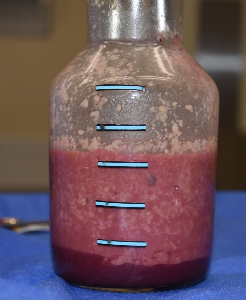 OR Snapshots - Liposuction and the Appearance of Boiling Fat - Explore ...