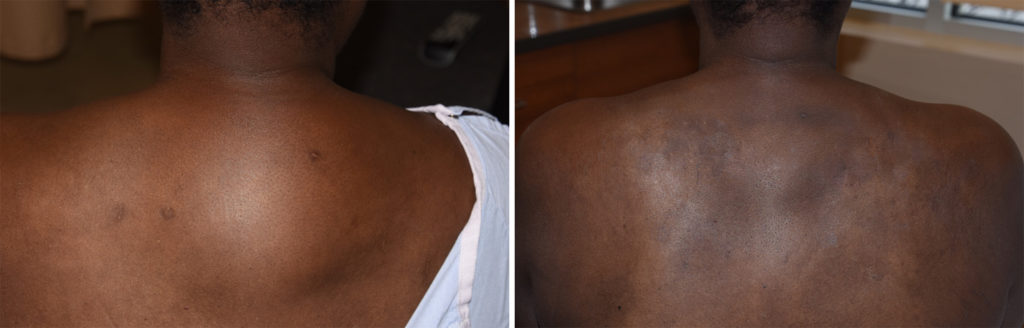 Plastic Surgery Case Study - Buffalo Hump Reduction with Power-Assisted ...