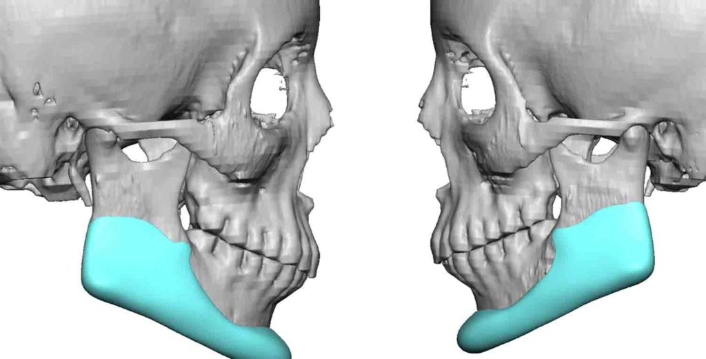 custom-jawline-implant-replacement-for-mapositioned-jaw-angle-implants ...
