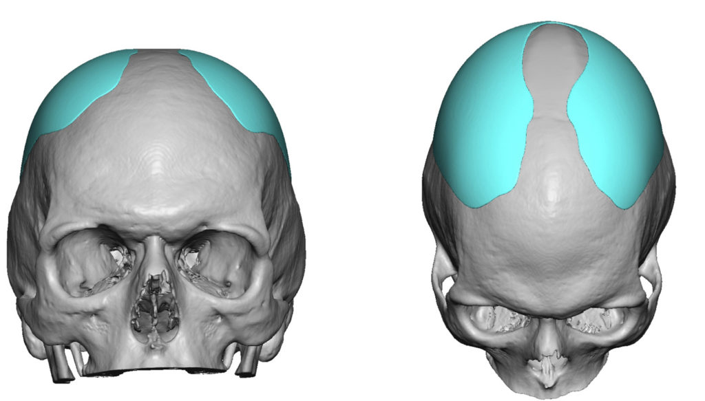 Plastic Surgery Case Study - Combining Custom Skull Implant ...