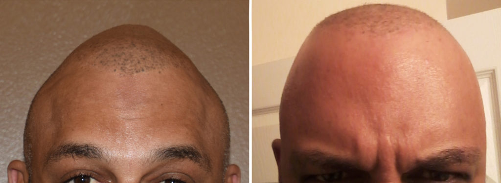 Plastic Surgery Case Study - Combining Custom Skull Implant ...