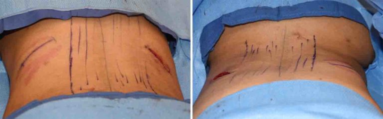 Plastic Surgery Case Study - Lower Rib Removals for Maximal Horizontal ...