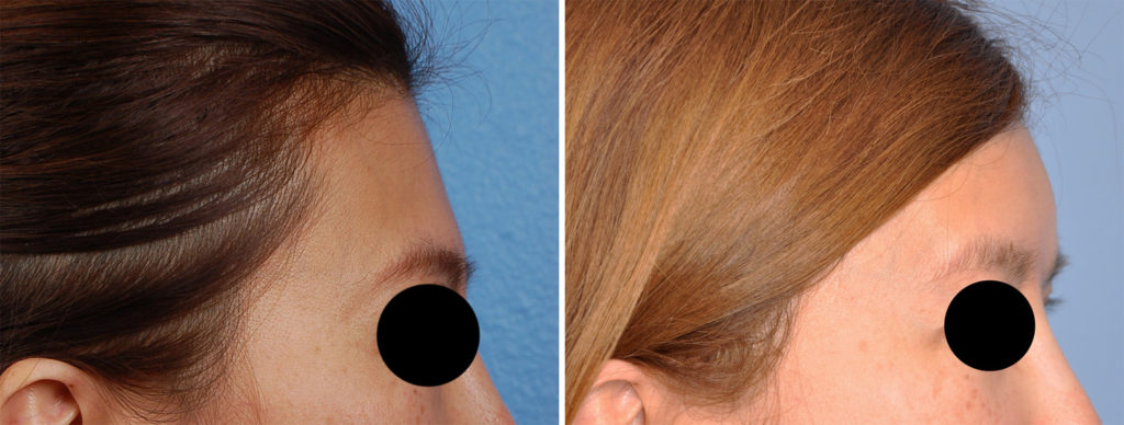 Plastic Surgery Case Study - Hydroxyapatite Cement Forehead ...