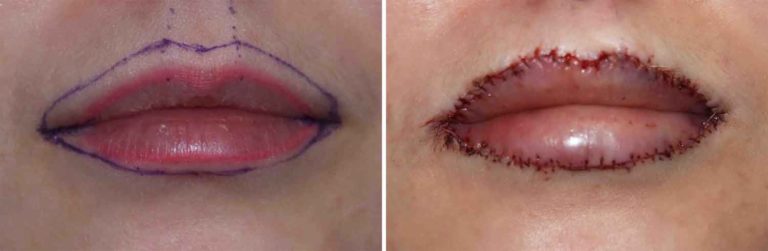 Plastic Surgery Case Study - Lip Advancements for Permanent Lip Liner ...