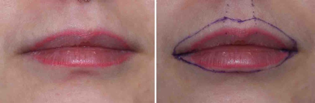 Plastic Surgery Case Study - Lip Advancements for Permanent Lip Liner ...
