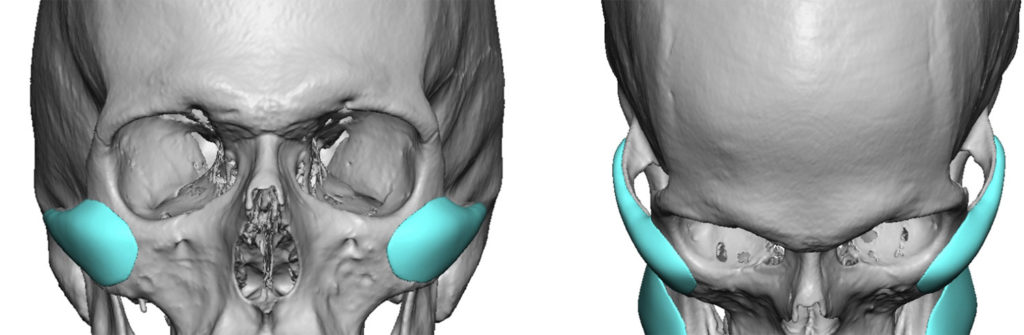 Custom Cheek Implants - Getting The High Model Cheek Look - Explore ...