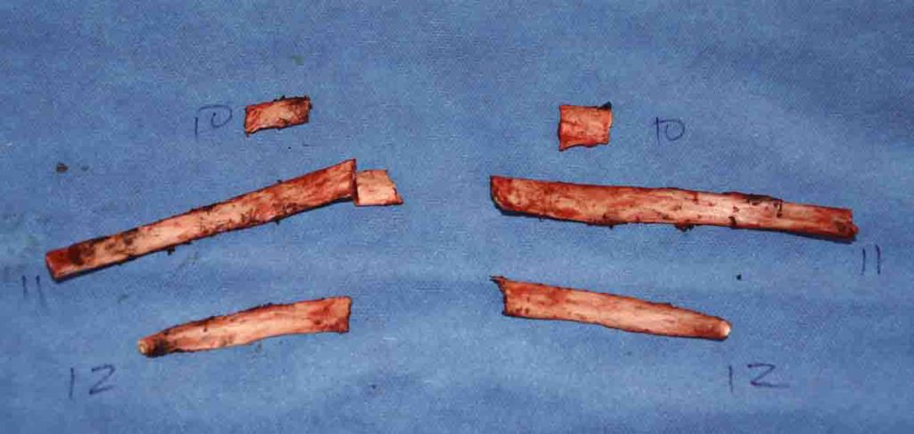 Plastic Surgery Case Study - Lower Rib Removals for Maximal Horizontal ...