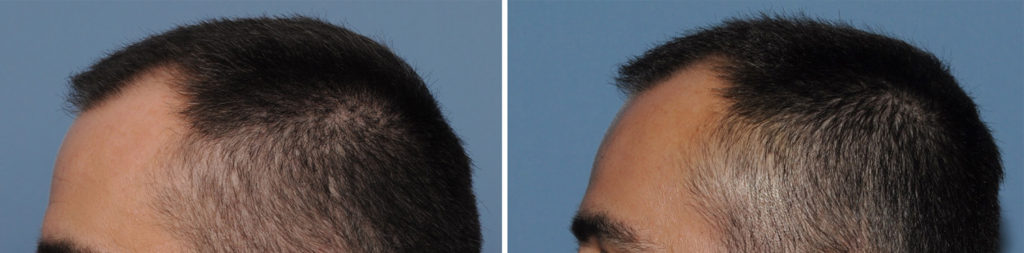 Plastic Surgery Case Study - Custom Skull Implant for Increasing the ...