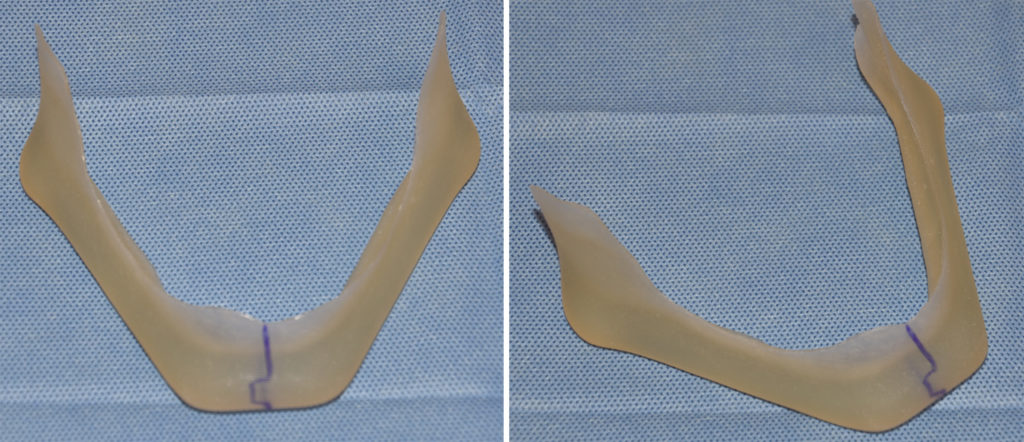 Technical Strategies - Interlocking the Custom Wrap Around Jawline ...