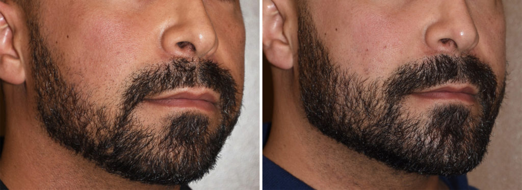 Plastic Surgery Case Study - Total Jawline Enhancement with Custom ...