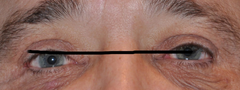 Aesthetic Vertical Orbital Dystopia Correction Strategies - Explore ...