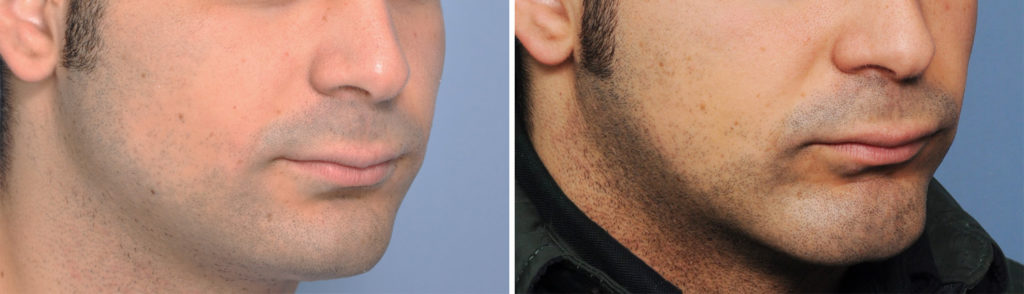 Plastic Surgery Case Study - Male Custom Chin Implant for Large ...