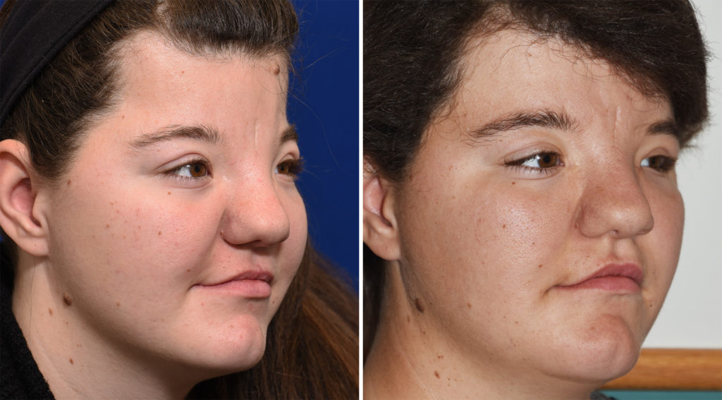 Plastic Surgery Case Study - Forehead Reconstruction with ...