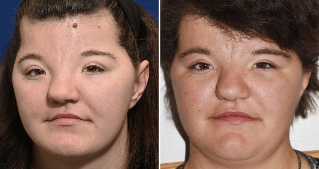 Plastic Surgery Case Study - Forehead Reconstruction with ...