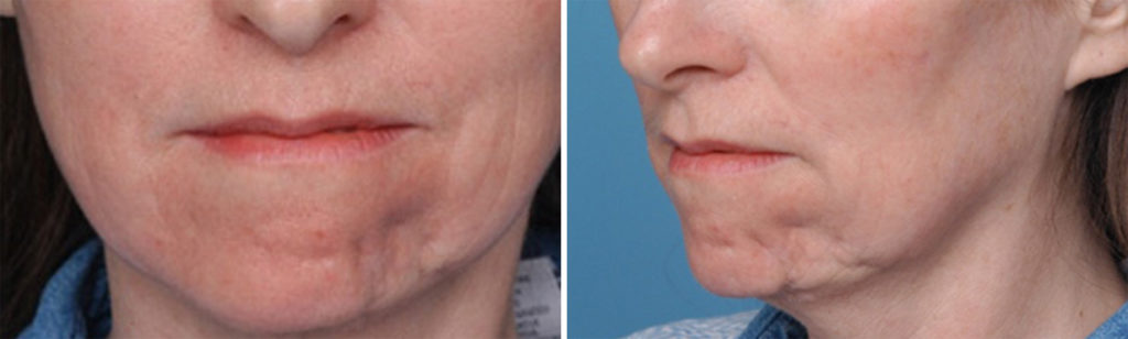 Plastic Surgery Case Study - Dermal-Fat Graft Chin Reconstruction ...