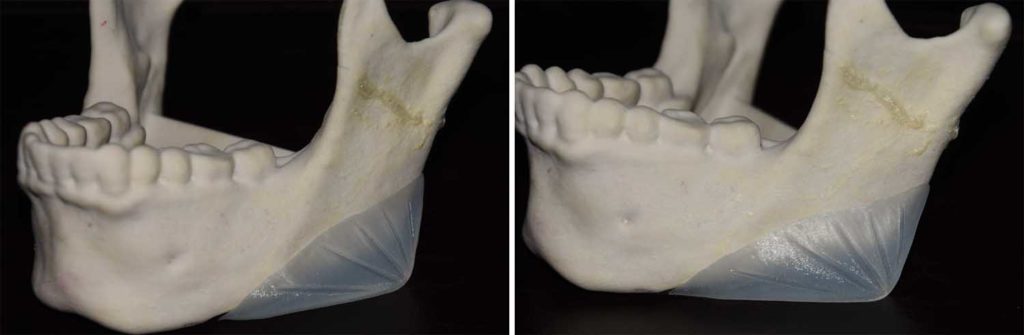The Role of Vertical Lengthening Jaw Angle Implants in Jaw Augmentation ...