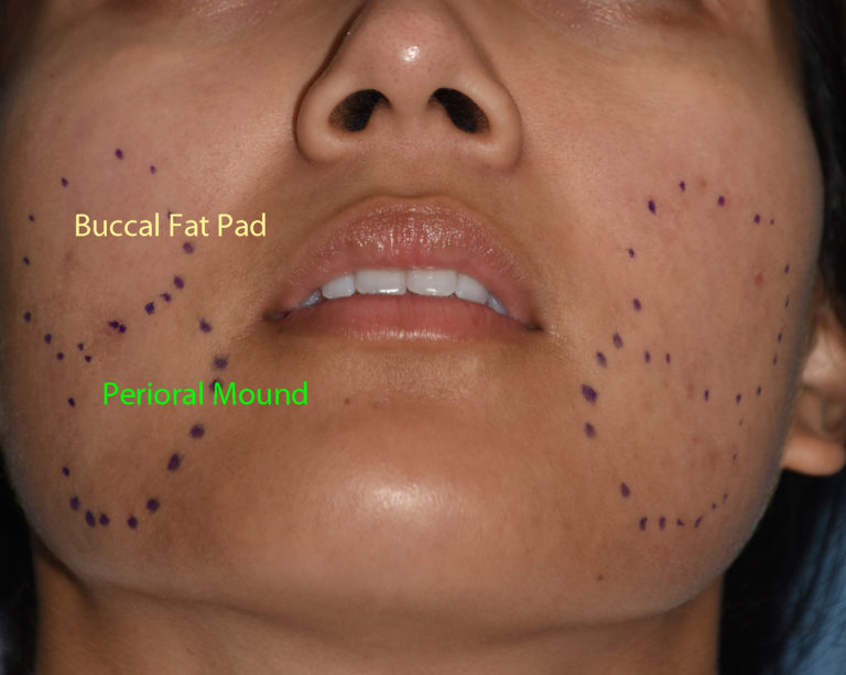Facial Fat Removal with Combined Buccal Lipectomies and Perioral Mound ...