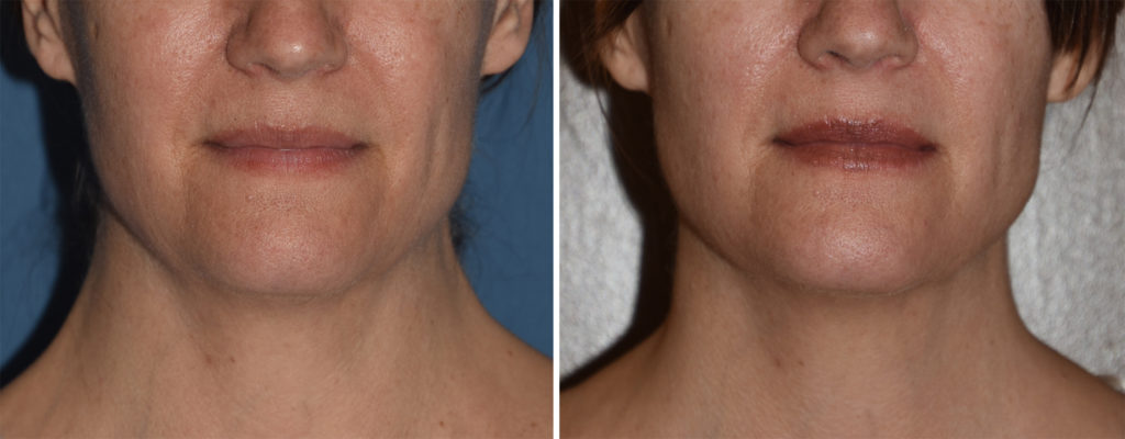 Plastic Surgery Case Study - Posterior Approach to Webbed Neck ...