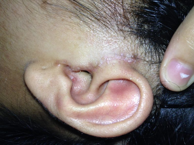 Clinic Snapshots - TMJ Arthroplasty Scar - Explore Plastic Surgery